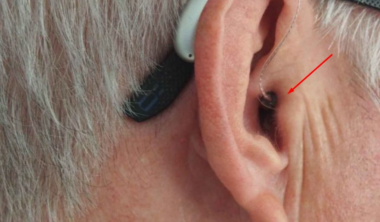 How Long Does Ringing In Ear Last After Car Accident?